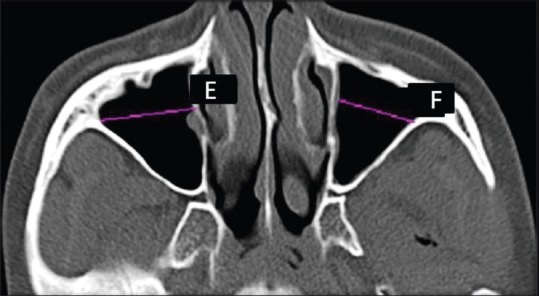 Sex Determination Using Maxillary Sinus Pmc
