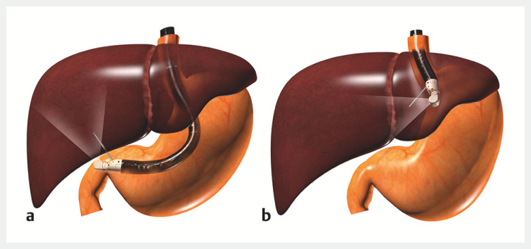Comparison Of Diagnostic Outcomes Safety And Cost Of Franseen Tip 19g