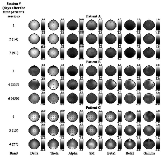 Real-time assessment of hypnotic depth, using an EEG-based brain-computer interface: a ...