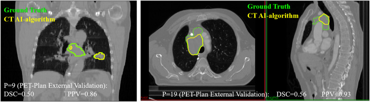 Development and evaluation of two open-source nnU-Net models for automatic segmentation of lung ...