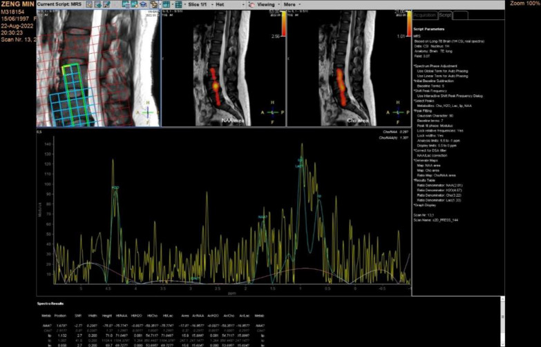 Evaluating lumbar disc degeneration by MRI quantitative metabolic indicators: the perspective of ...