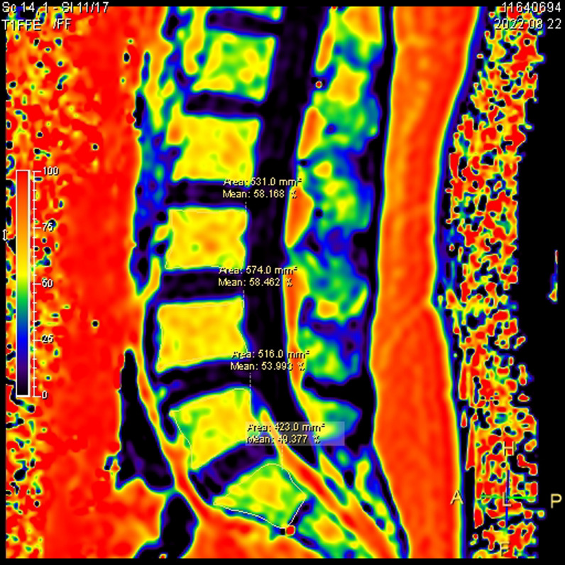 Evaluating lumbar disc degeneration by MRI quantitative metabolic indicators: the perspective of ...