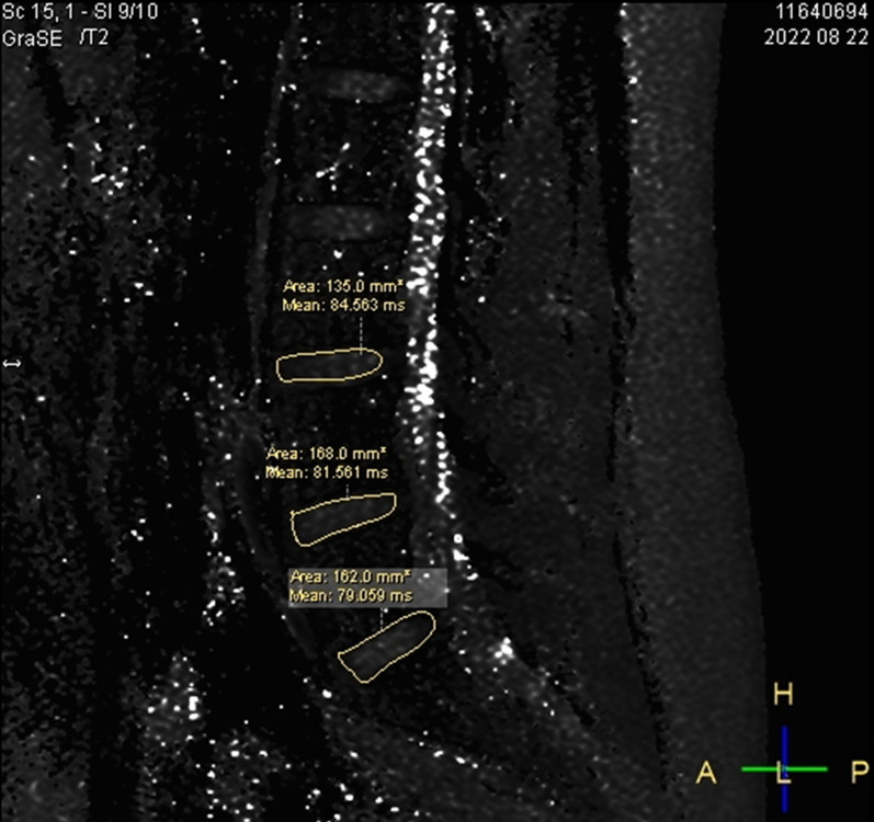 Evaluating lumbar disc degeneration by MRI quantitative metabolic indicators: the perspective of ...