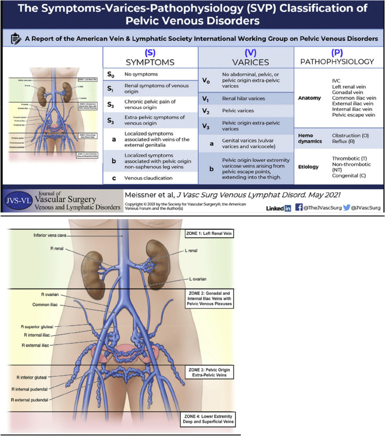 Pelvic venous congestion syndrome: female venous congestive syndromes and endovascular treatment ...
