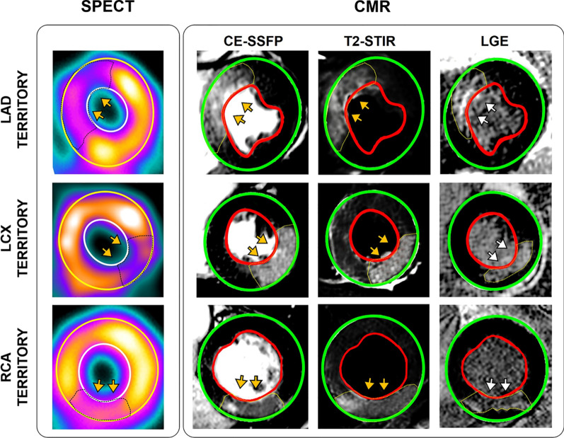 Retrospective assessment of at-risk myocardium in reperfused acute ...