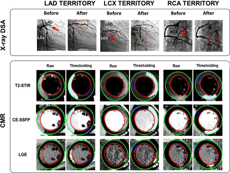 Retrospective assessment of at-risk myocardium in reperfused acute myocardial infarction ...