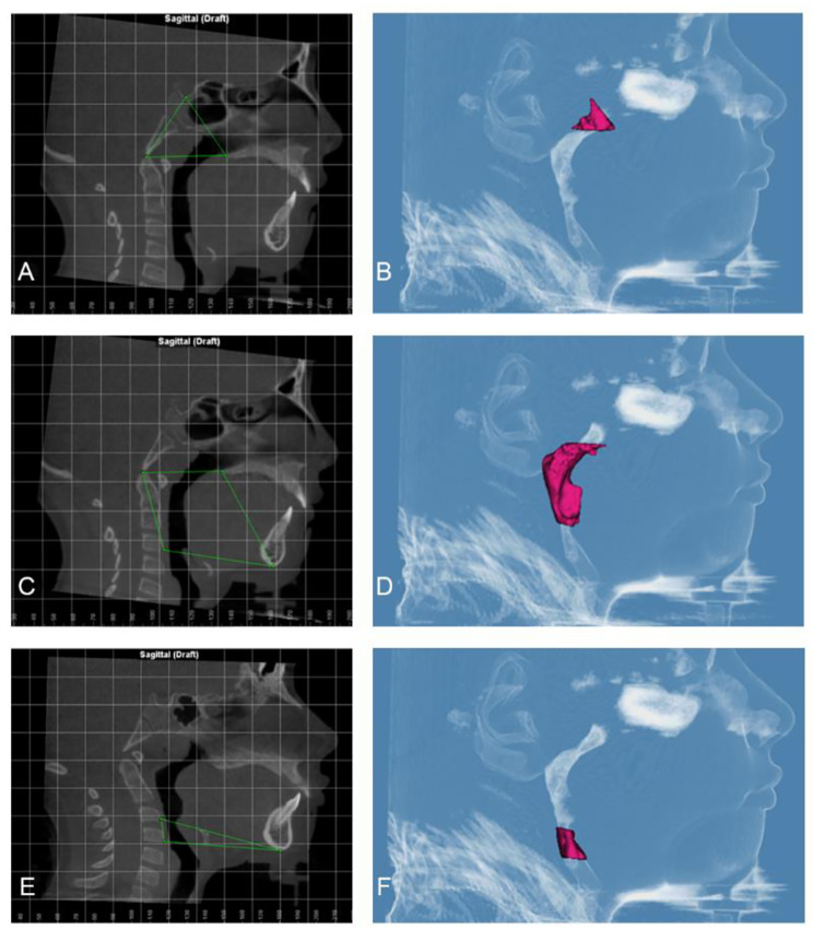 Three-dimensional computed tomography analysis of airway volume in growing class II patients ...