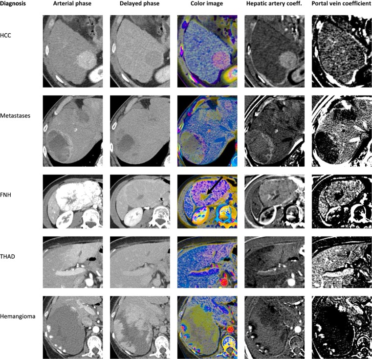 Classification of Hypervascular Liver Lesions Based on Hepatic Artery and Portal Vein Blood ...
