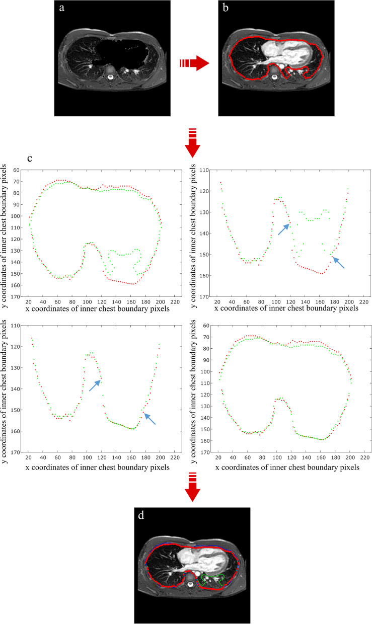 A new tool for assessing Pectus Excavatum by a semi-automatic image processing pipeline ...