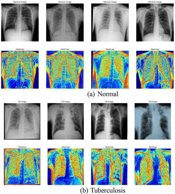Enhanced tuberculosis detection using Vision Transformers and ...