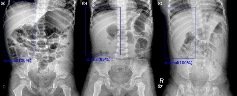 Performance of deep learning-based algorithm for detection of ileocolic intussusception on ...