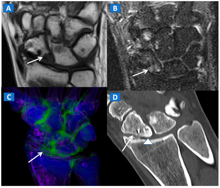 Identification of Traumatic Bone Marrow Oedema: The Pearls and Pitfalls of Dual-Energy CT (DECT ...