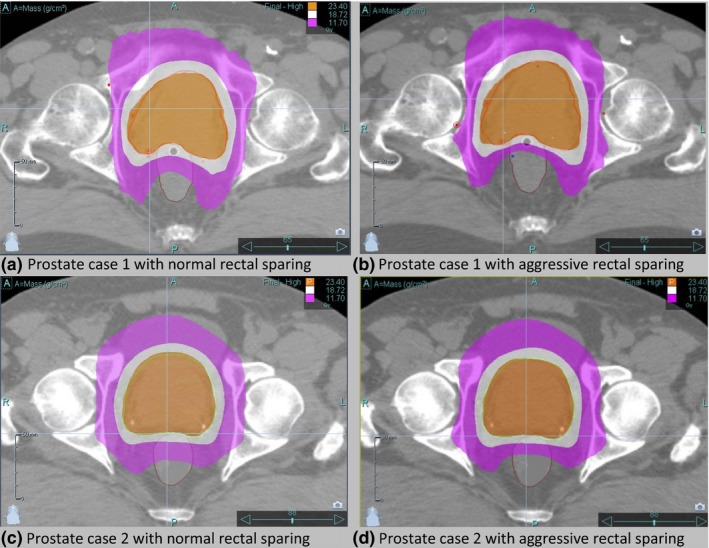 Determining efficient helical IMRT modulation factor from the MLC leaf‐open time distribution on ...