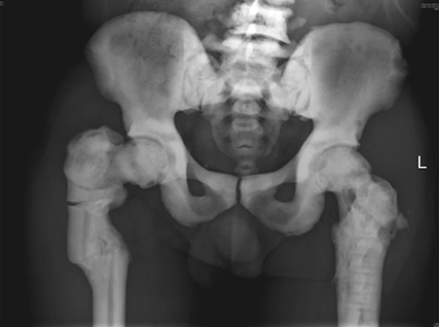 Further understanding on osteopetrotic femoral fractures: a case report and literature review - PMC
