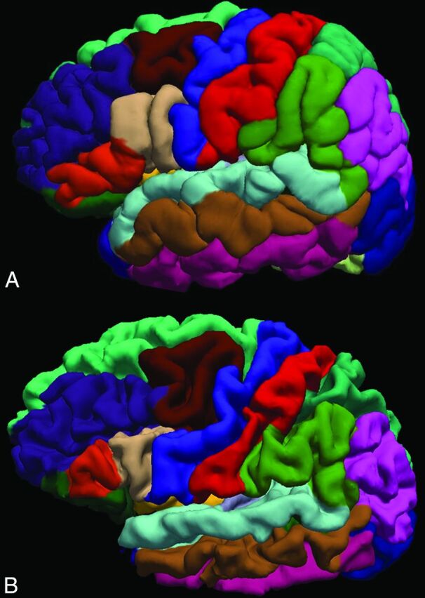 Brain Region Specific Degeneration With Disease Progression In Late