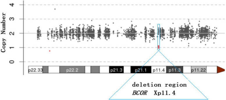 A novel deletion mutation in the BCOR gene is associated with oculo-facio-cardio-dental syndrome ...