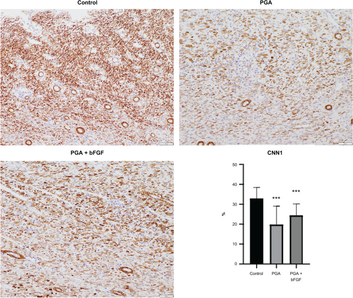 Application of polyglycolic acid sheets and basic fibroblast growth factor to prevent esophageal ...