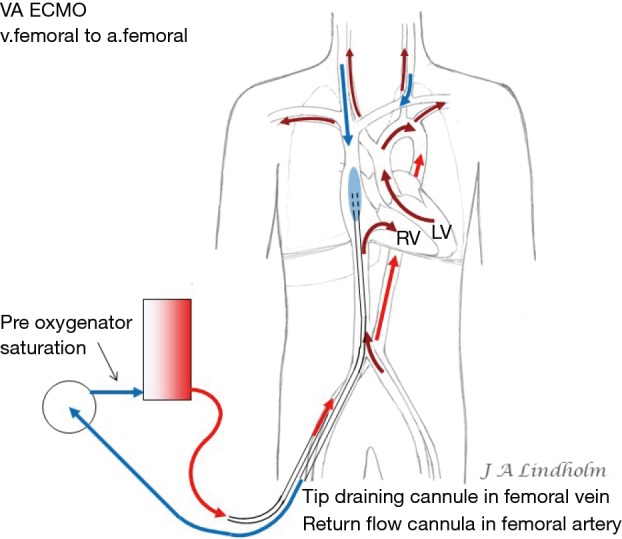 Cannulation for veno-venous extracorporeal membrane oxygenation - PMC