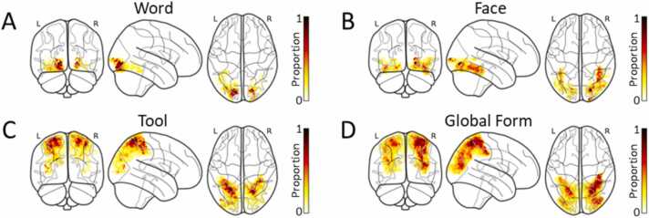 Differential functional reorganization of ventral and dorsal visual pathways following childhood ...