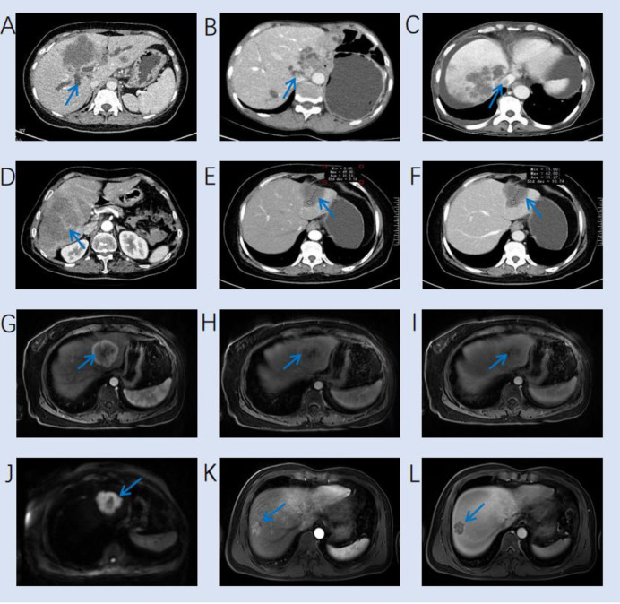 Comparison of MRI and CT based deep learning radiomics analyses and their combination for ...