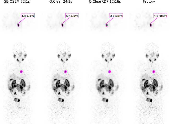 Quantitative 177Lu SPECT/CT imaging for personalized dosimetry using a ring-shaped CZT-based ...