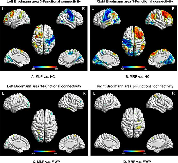 Changes in sensory-related brain networks of patients with moyamoya disease with limb ...