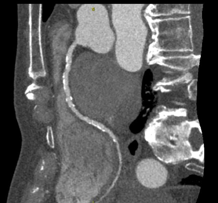 Cardiac Ct Angiography In Current Practice An American Society For