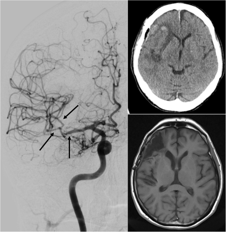 Vasospasm and delayed cerebral ischemia after uneventful clipping of an unruptured intracranial ...