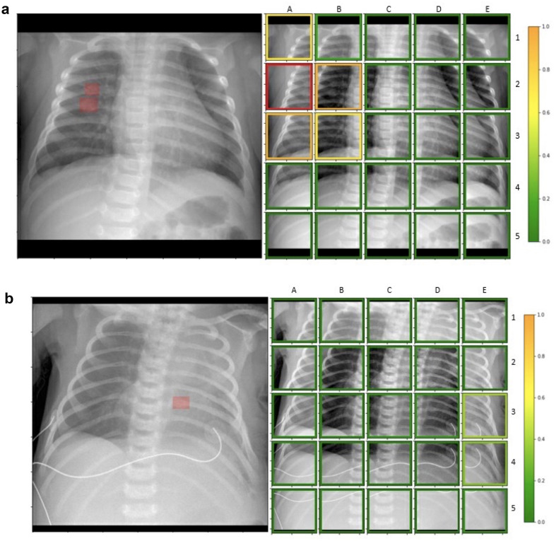A Patch-Based Deep Learning Approach for Detecting Rib Fractures on Frontal Radiographs in Young ...