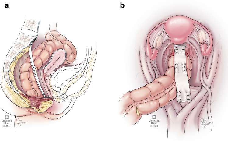 Ventral mesh rectopexy for recurrent rectal prolapse after Altemeier perineal ...