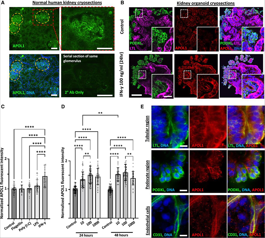 Interferon γ Induces Combined Pyroptotic Angiopathy And Apol1
