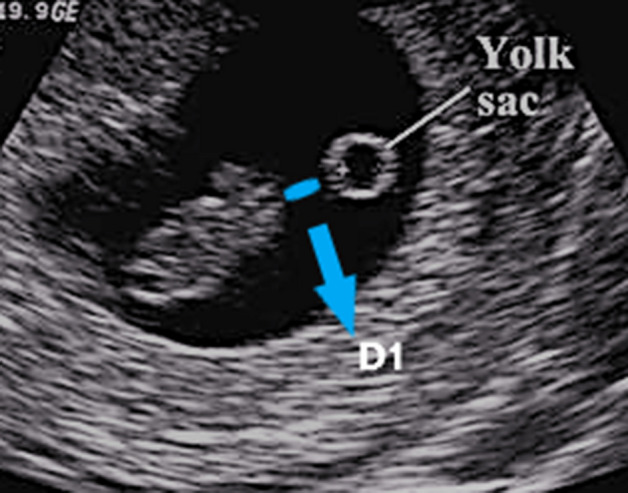 Fetal sex prediction measuring yolk sac size and yolk sac–fetal pole distance in the first ...