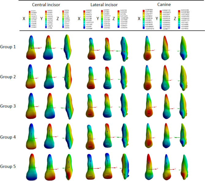 Three-dimensional finite element analysis of maxillary molar distalization treated with clear ...
