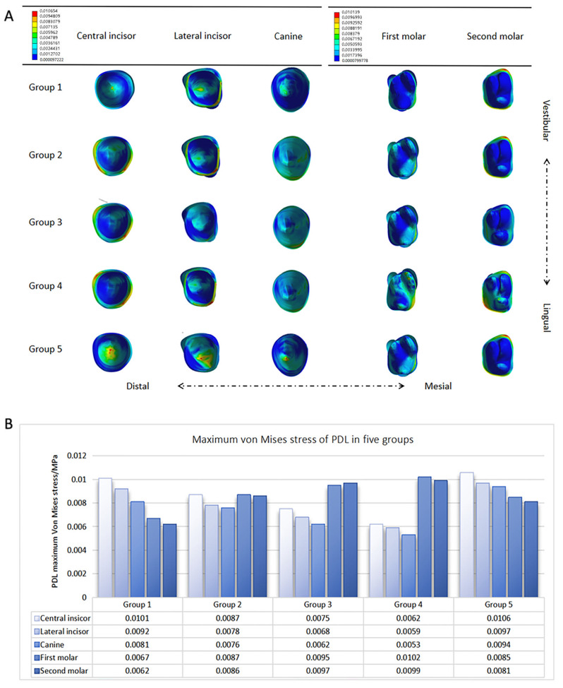 Three-dimensional finite element analysis of maxillary molar distalization treated with clear ...