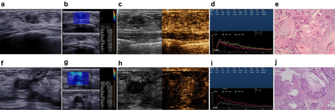 Development of a nomogram for predicting malignancy in BI-RADS 4 breast lesions using contrast ...