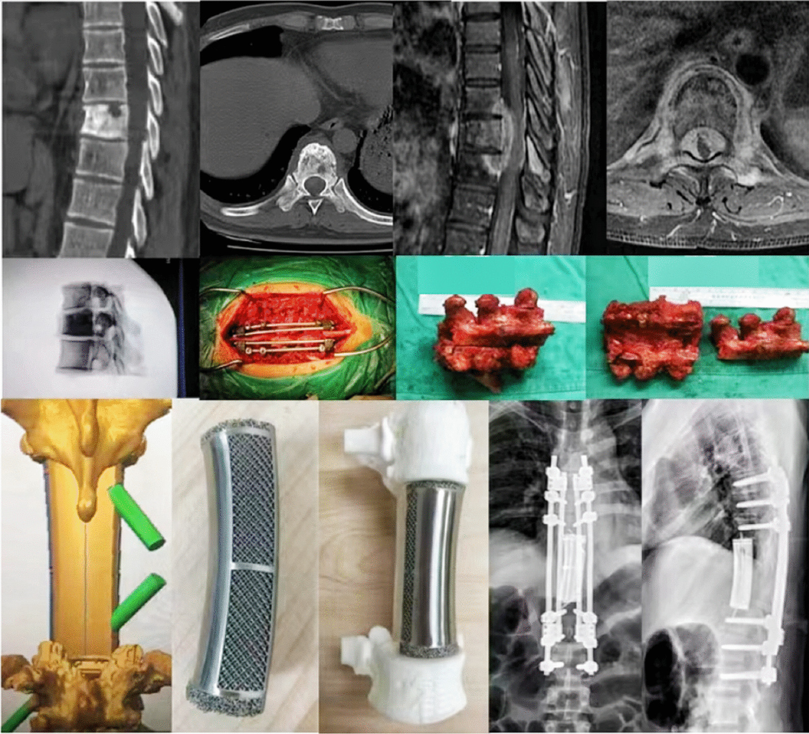 The application of 3D-printed auto-stable artificial vertebral body in en bloc resection and ...