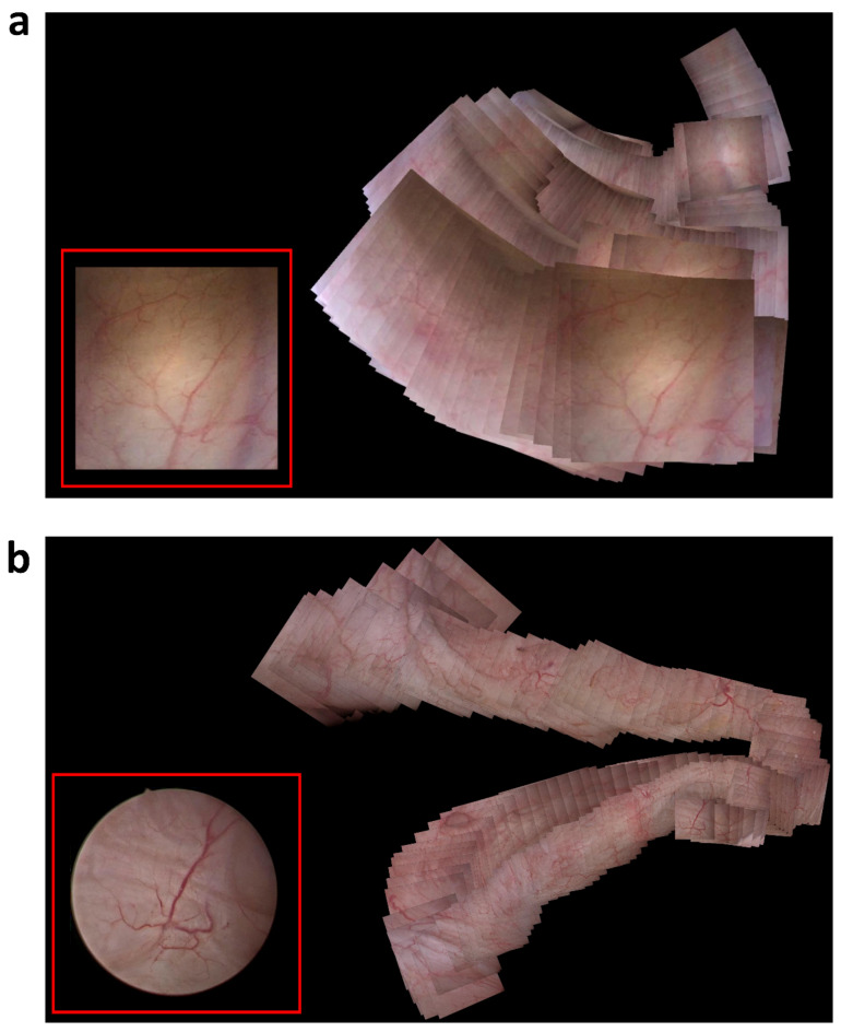 Bladder image stitching algorithm for navigation and referencing using a standard cystoscope - PMC