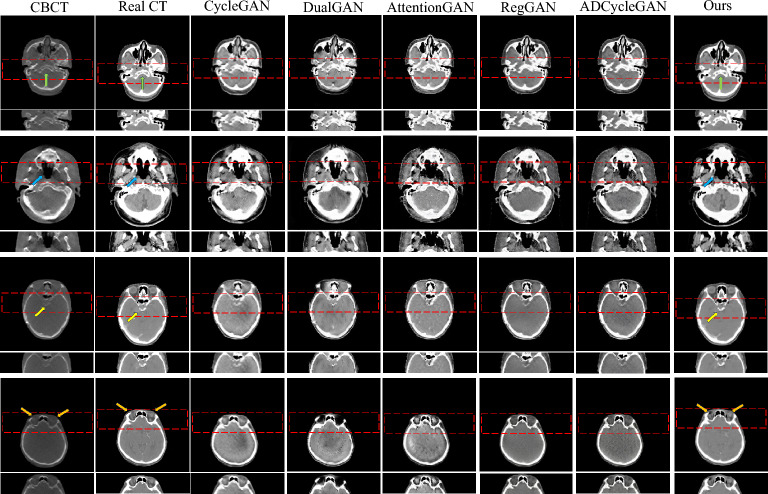 Synthetic CT generation based on CBCT using improved vision transformer ...