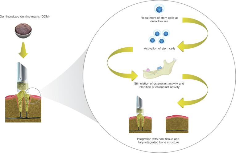 Demineralized dentin matrix for bone regeneration in dentistry: A critical update - PMC