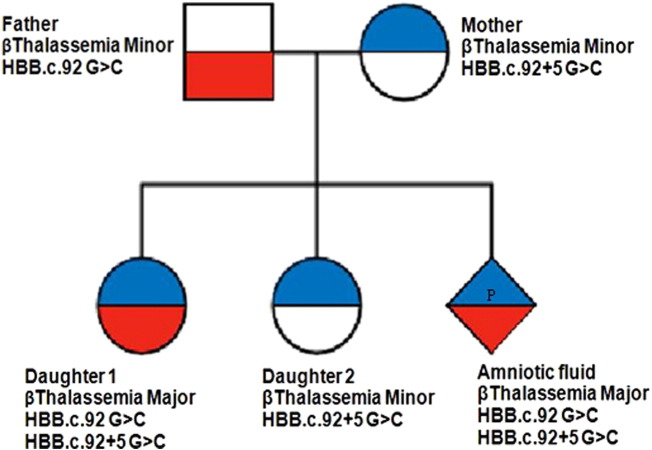 Compound heterozygous β+ β0 mutation of HBB gene leading to β ...