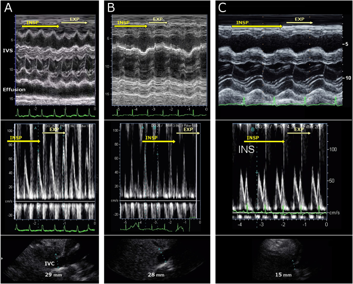 Subacute Effusive Constrictive Pericarditis Echocardiography Guided