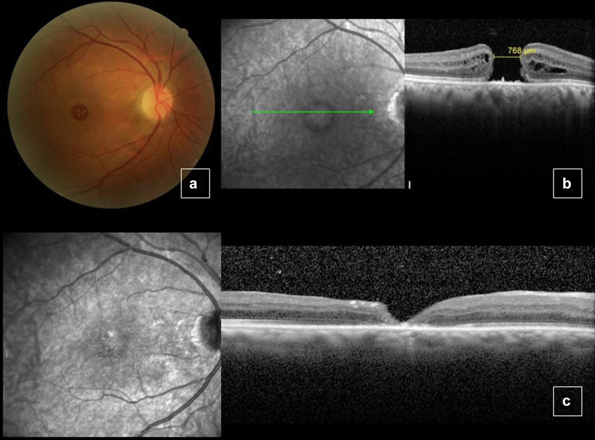 Pedicle internal limiting membrane flap technique for very large macular holes: a preliminary ...