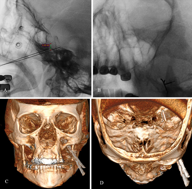 Bipolar, high-voltage, long-duration pulsed radiofrequency ablation of the Gasserian ganglion ...