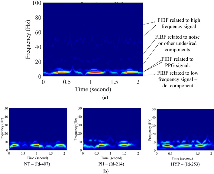 Optimized deep neural network models for blood pressure classification using Fourier analysis ...