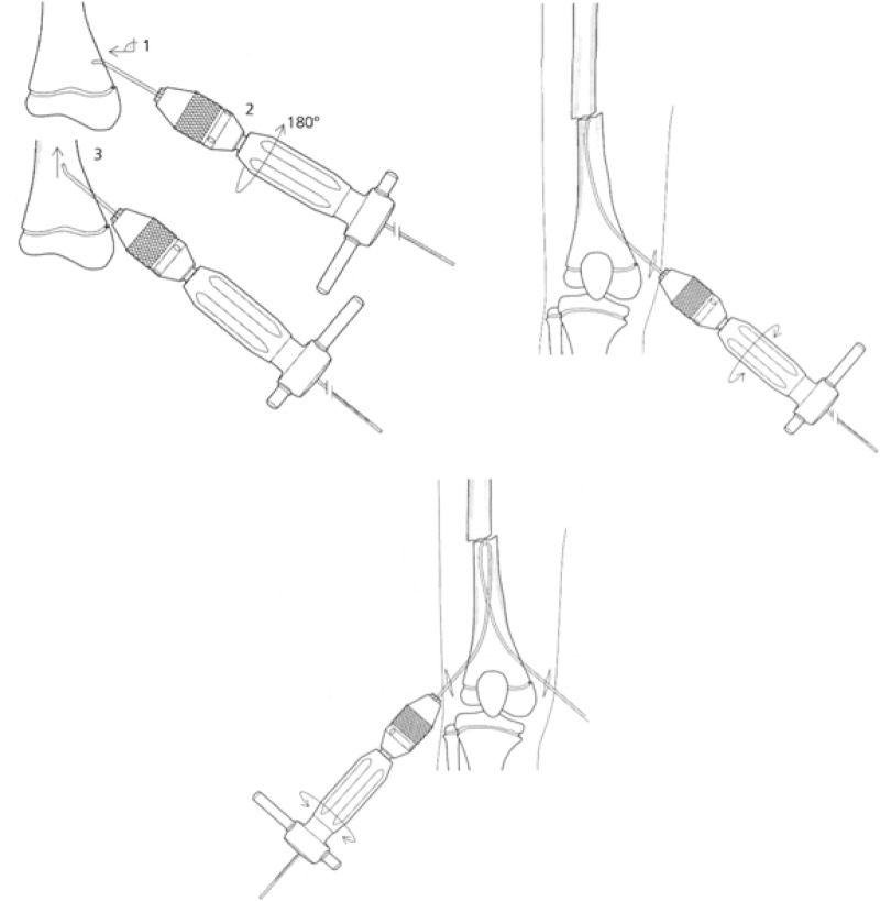 Elastic Stable Intramedullary Nailing for Fractures in Children - Principles, Indications ...