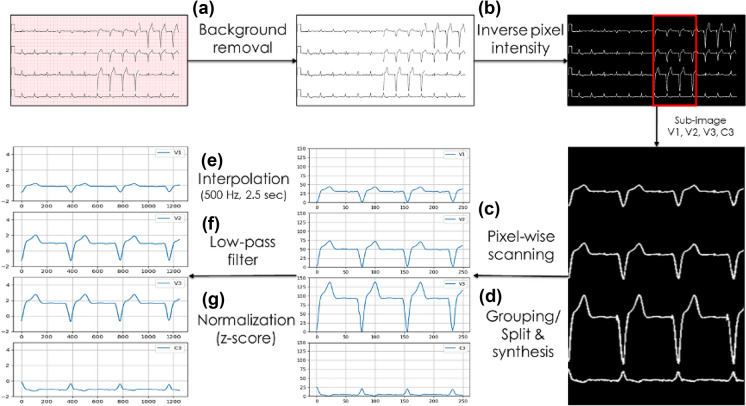An artificial intelligence-enabled ECG algorithm for identifying ventricular premature ...