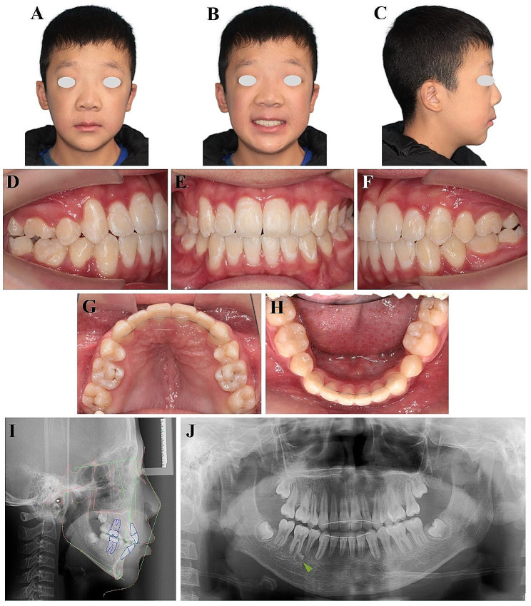 Treatment and genetic analysis of multiple supernumerary and impacted ...