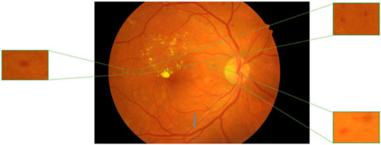 Convolutional block attention gate-based Unet framework for microaneurysm segmentation using ...