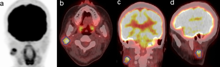 Applying deep learning-based ensemble model to [18F]-FDG-PET-radiomic features for ...