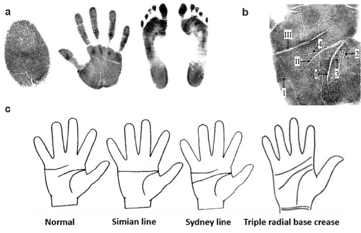 Palmprint Phenotype Feature Extraction and Classification Based on Deep Learning - PMC